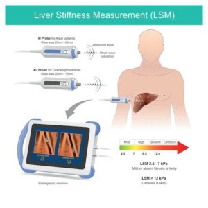 Non-Invasive Liver Fibrosis Test in Bangalore | Liver Fibrosis test